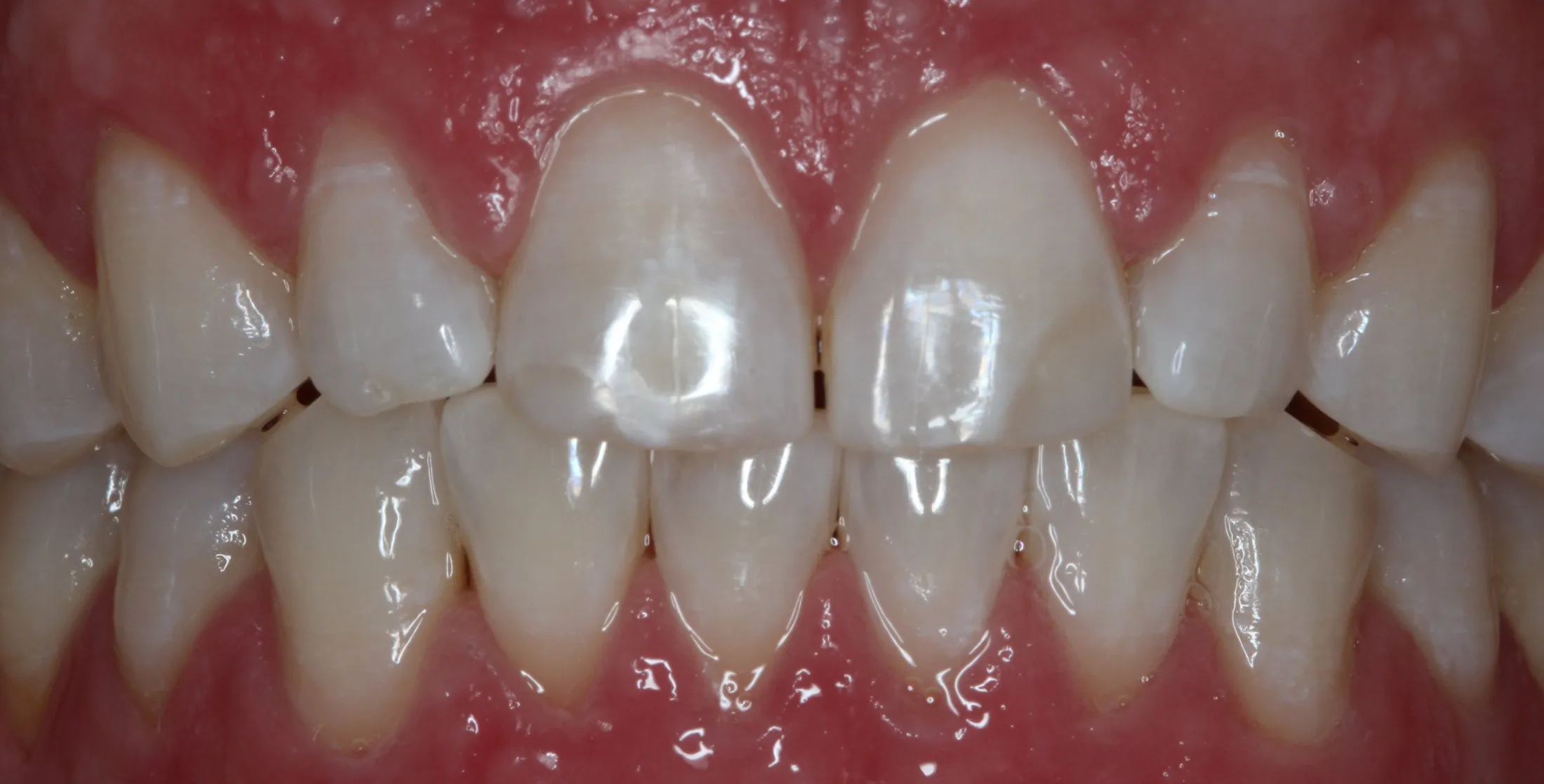 Zoom Whitening | Fitchburg MA | Teeth Whitening | Brighten Teeth